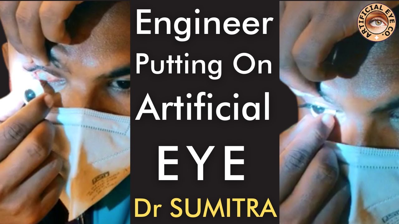 Engineer wearing an artificial eye | Dr Sumitra | ocular prosthesis ...