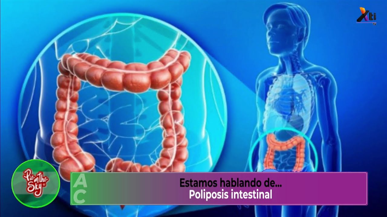 Poliposis intestinal: causas, signos, síntomas y tratamiento - YouTube