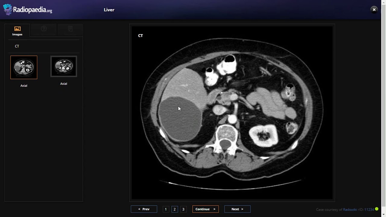ct gan case - YouTube
