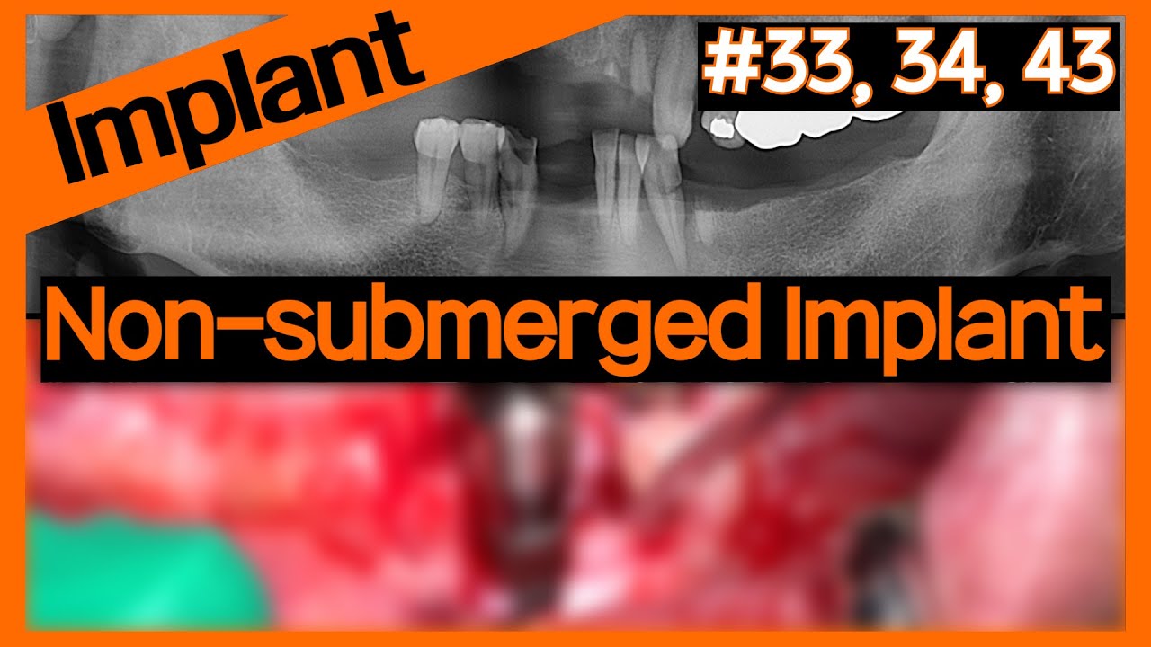 [Online Surgery] OneGuide surgery with US implant - YouTube