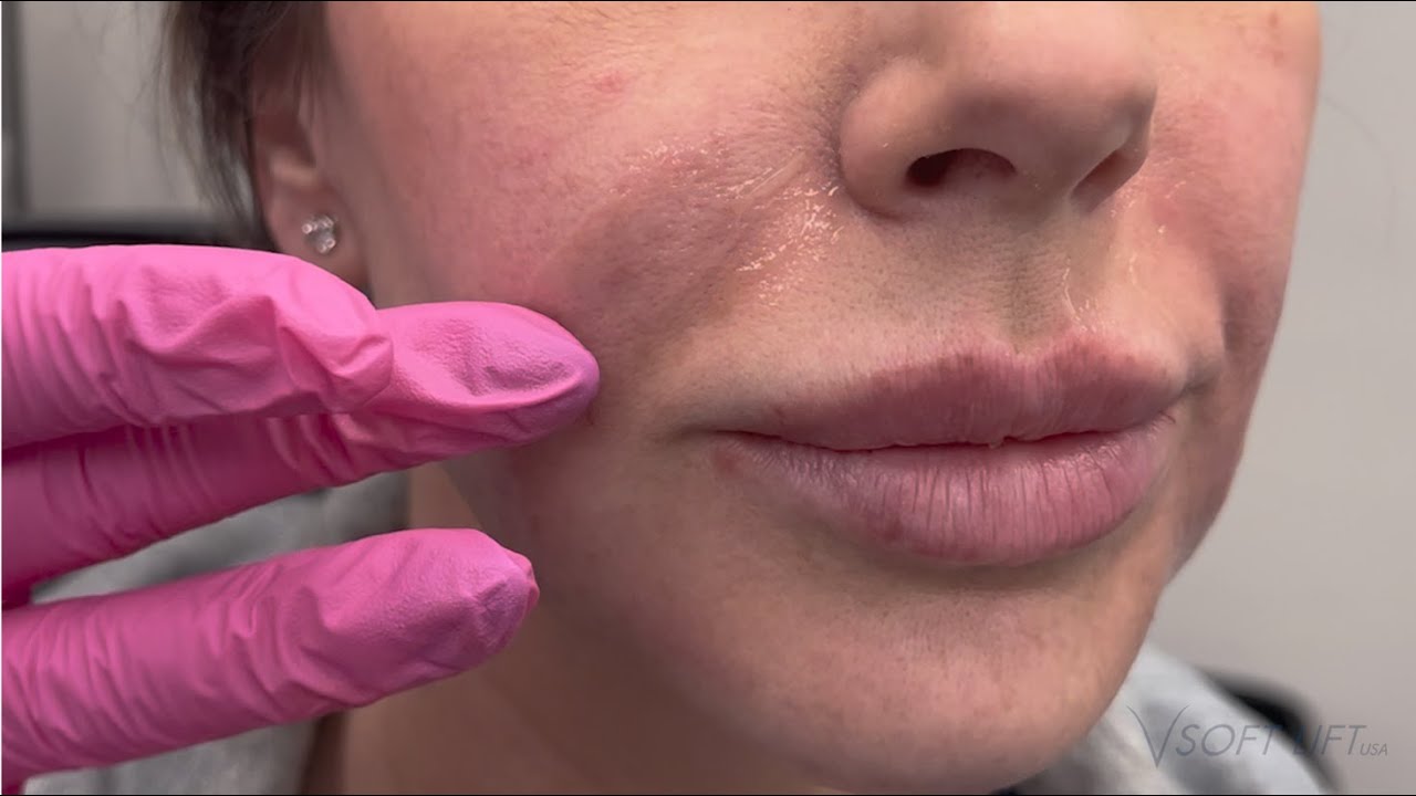 Softening Nasolabial Lines with VSoft Smooth Threads - YouTube