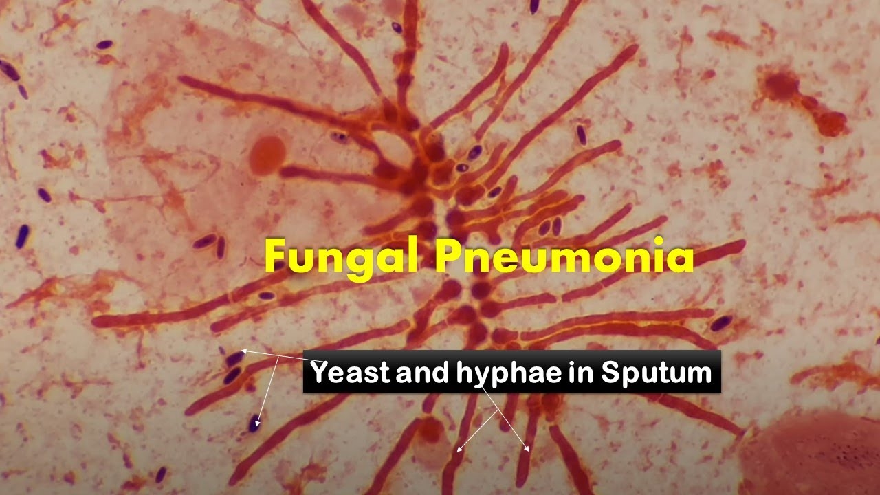 Heavy load of fungus in Sputum Microscopy - YouTube