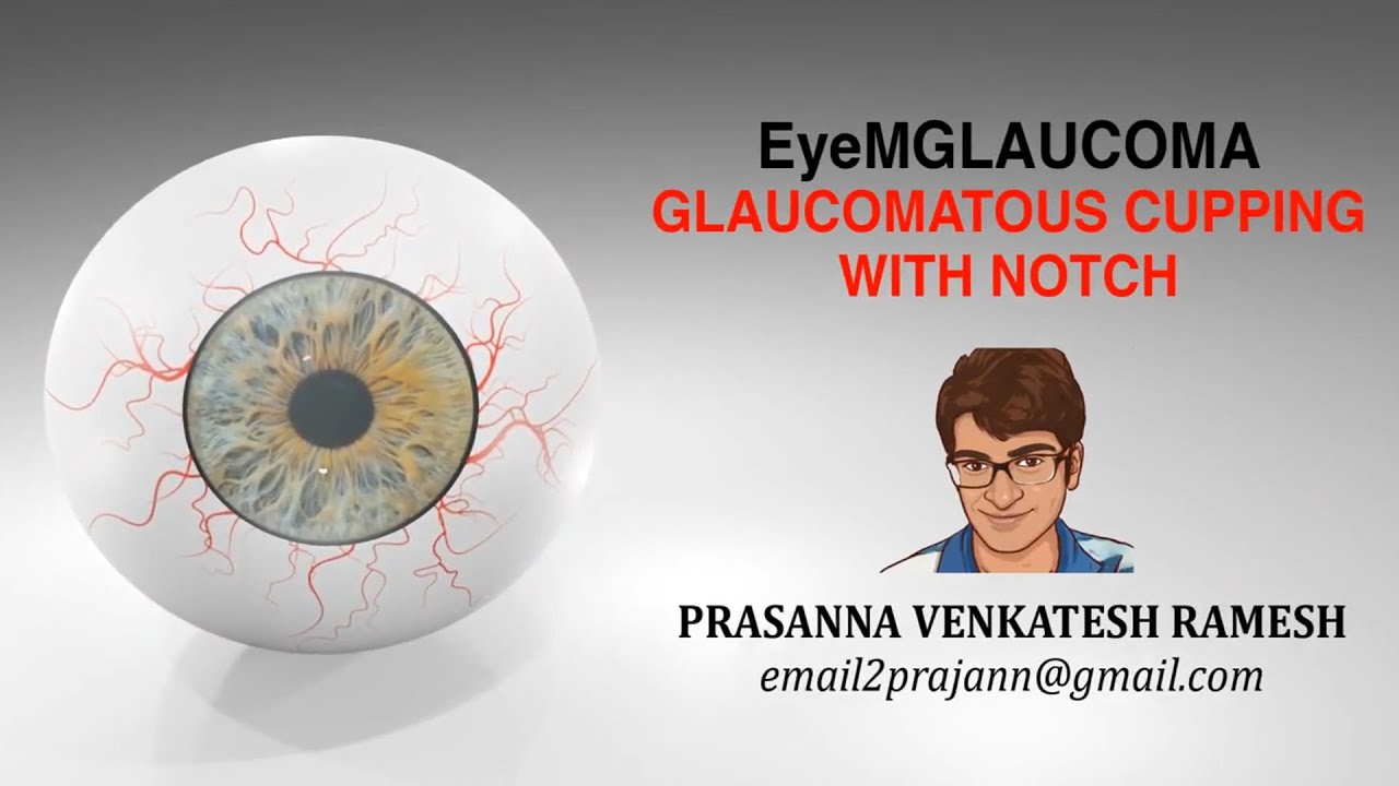 Innovative Pedagogy - Glaucomatous Notch with Corresponding RNFL Defect ...