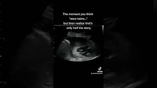 Quadruplet Ultrasound One In 40 Million Odds: Couple Welcomes