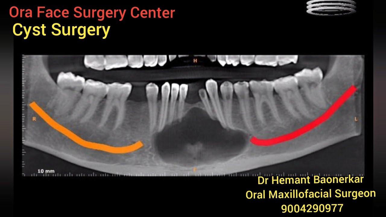 Cyst Surgery By Dr Hemant Baonerkar - YouTube