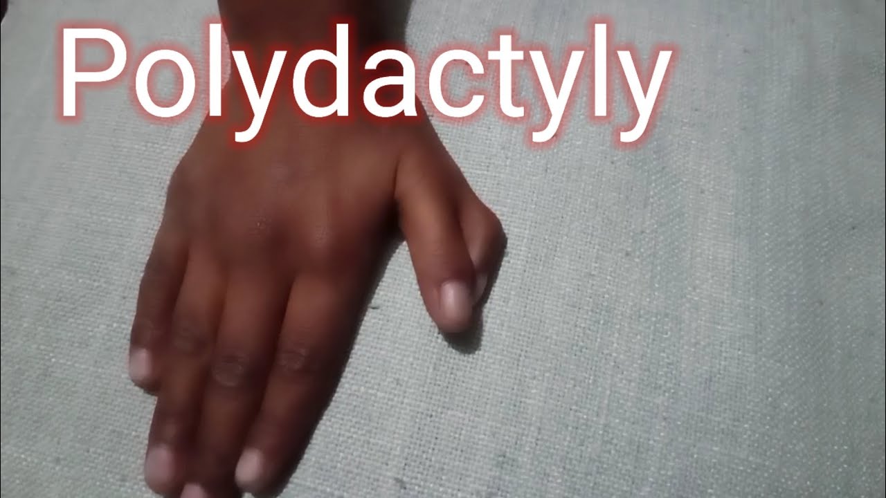 Polydactyly# Double Thumb - YouTube