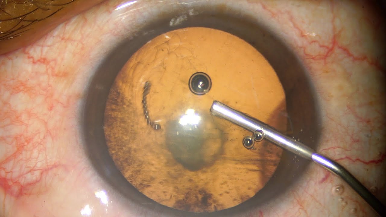 Soft Cataract + Easy Case for beginners - Dr Ramakrishna Tadanki - YouTube