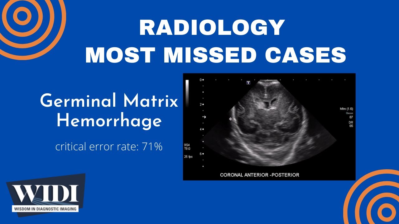 Most Missed Cases Germinal Matrix Hemorrhage Youtube