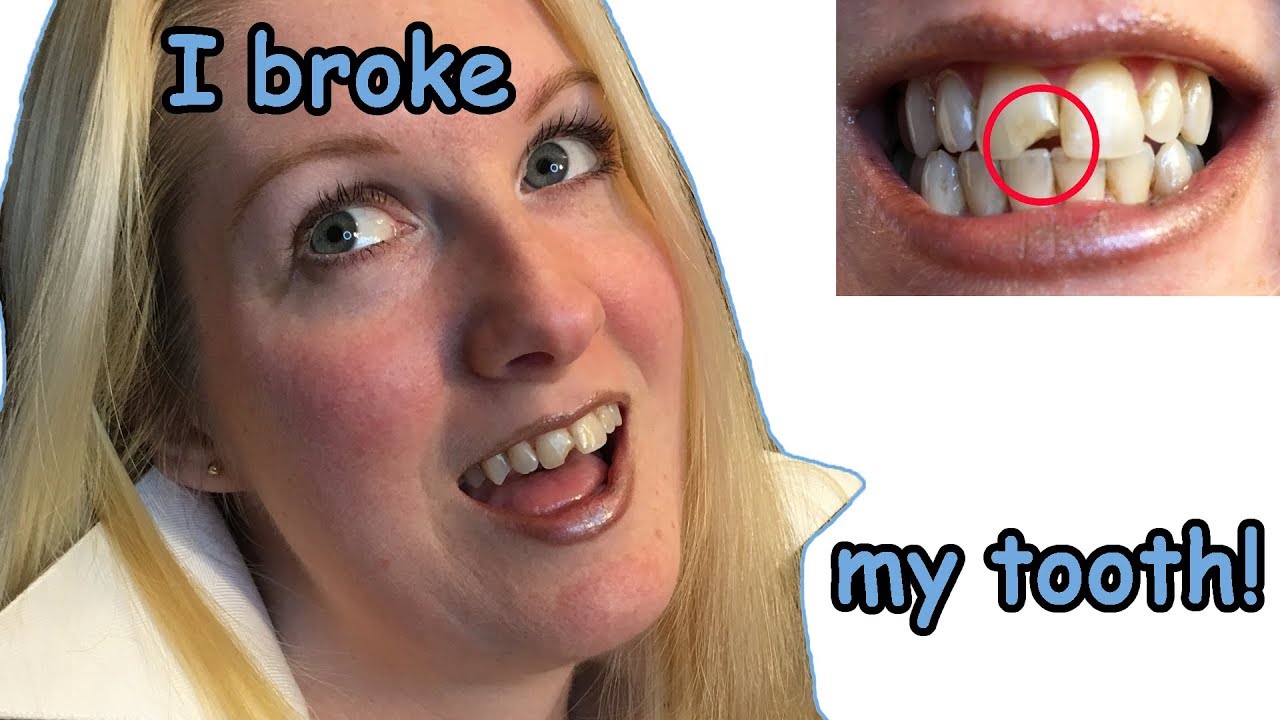 I broke my tooth! - YouTube
