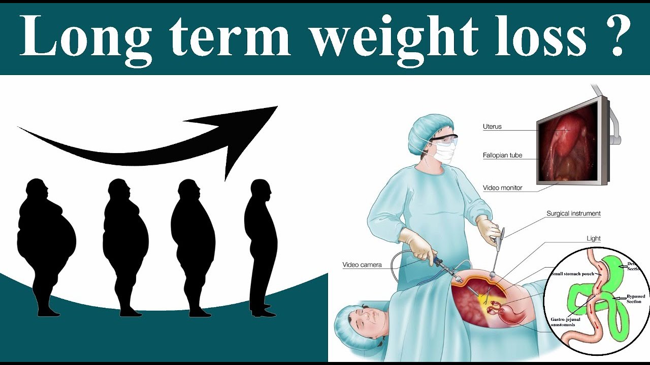 World leaders in MGB-OAGB weight loss surgery Dr Rutledge & Dr Kular on ...