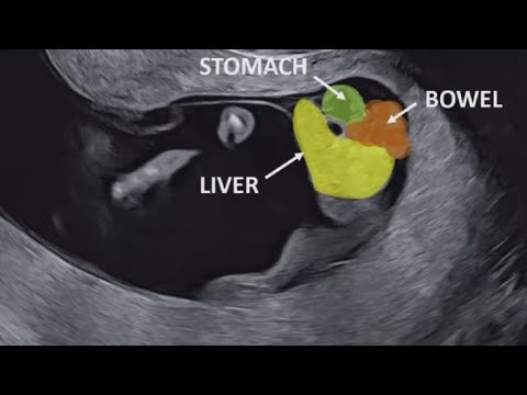 Fetal body stalk Anomaly imaging. - YouTube