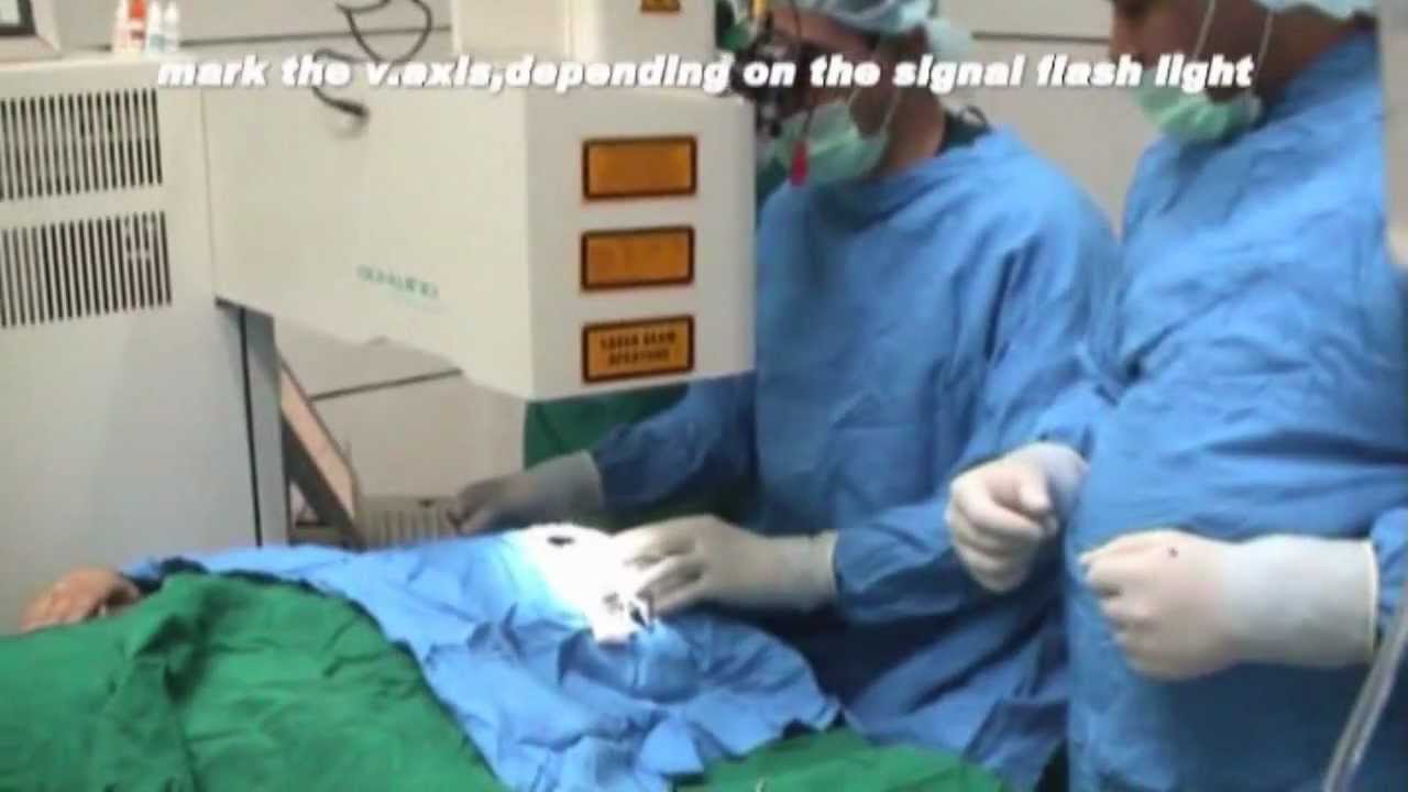 KERATOCONUS ,KERA RING, Refractive Surgery ,BY DR. KAWA QARADAGHI - YouTube