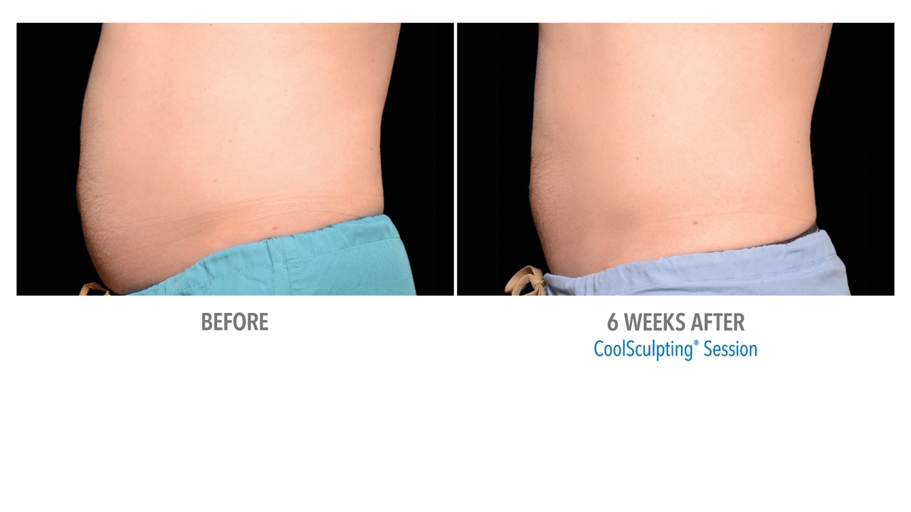 Cost Of Coolsculpting Studio City LA Call Us Now! 818-760-5204 - YouTube