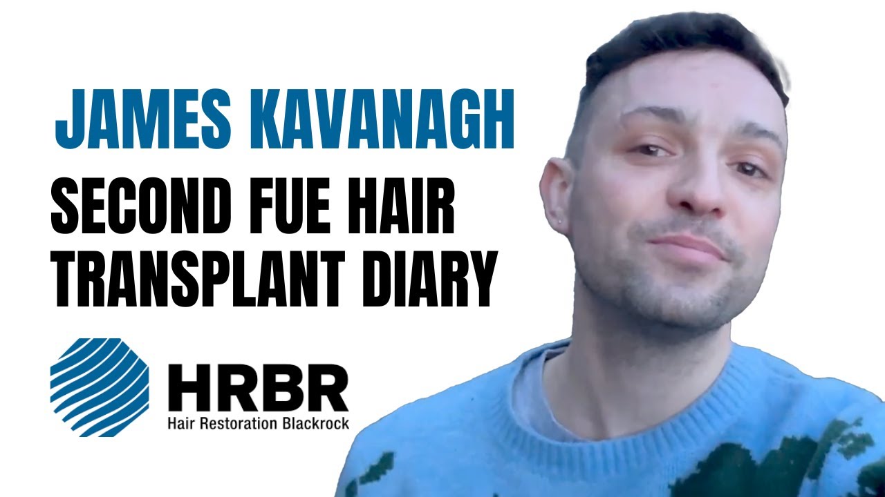 James Kavanagh Second FUE Hair Transplant Diary - Hair Restoration ...