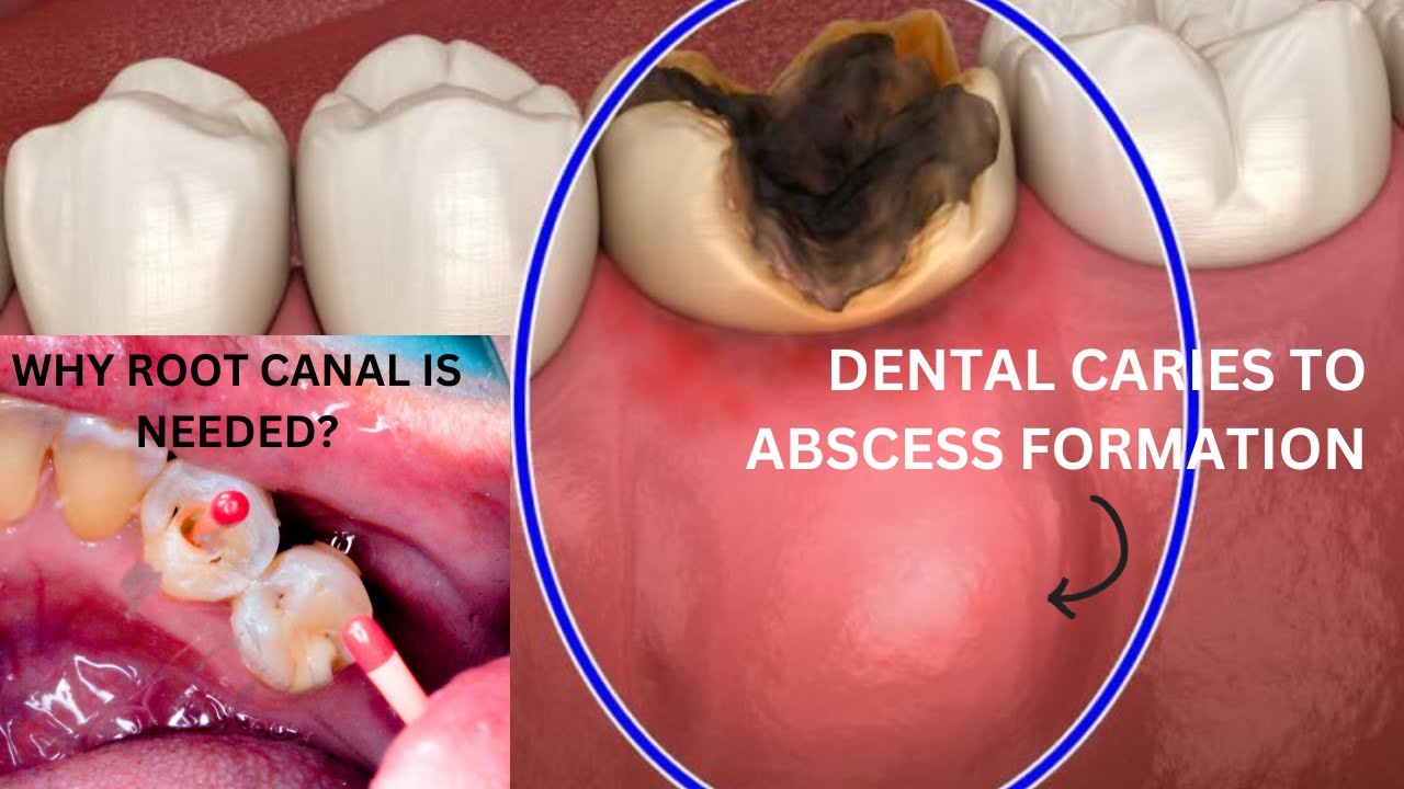 Dental Caries to Abscess Formation- Why Root Canal is Needed? - YouTube