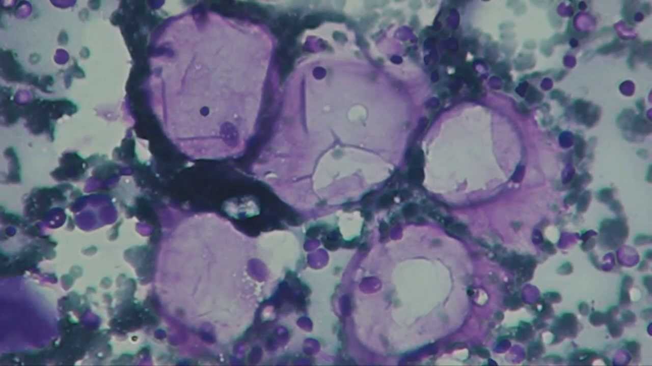 Hematology. Bone Marrow. Fat cells. - YouTube