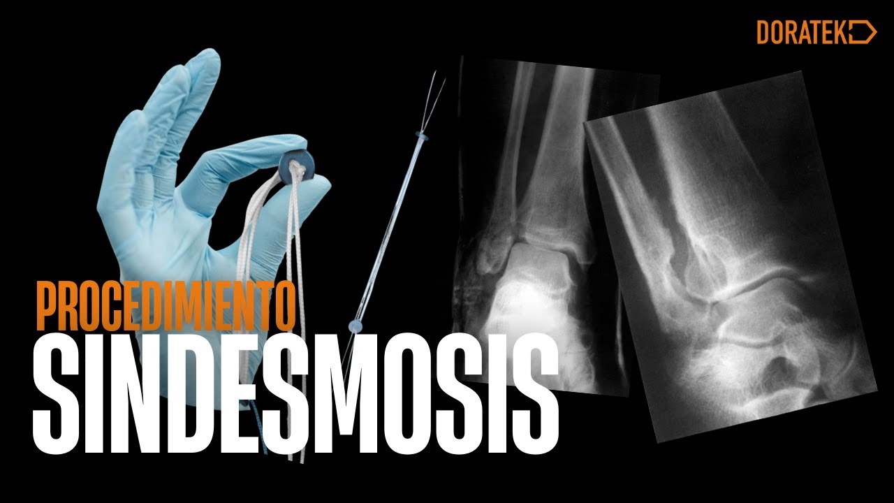 Procedimiento Artroscópico de Sindesmosis con Botón 🔍 | Sistema Doratek ...