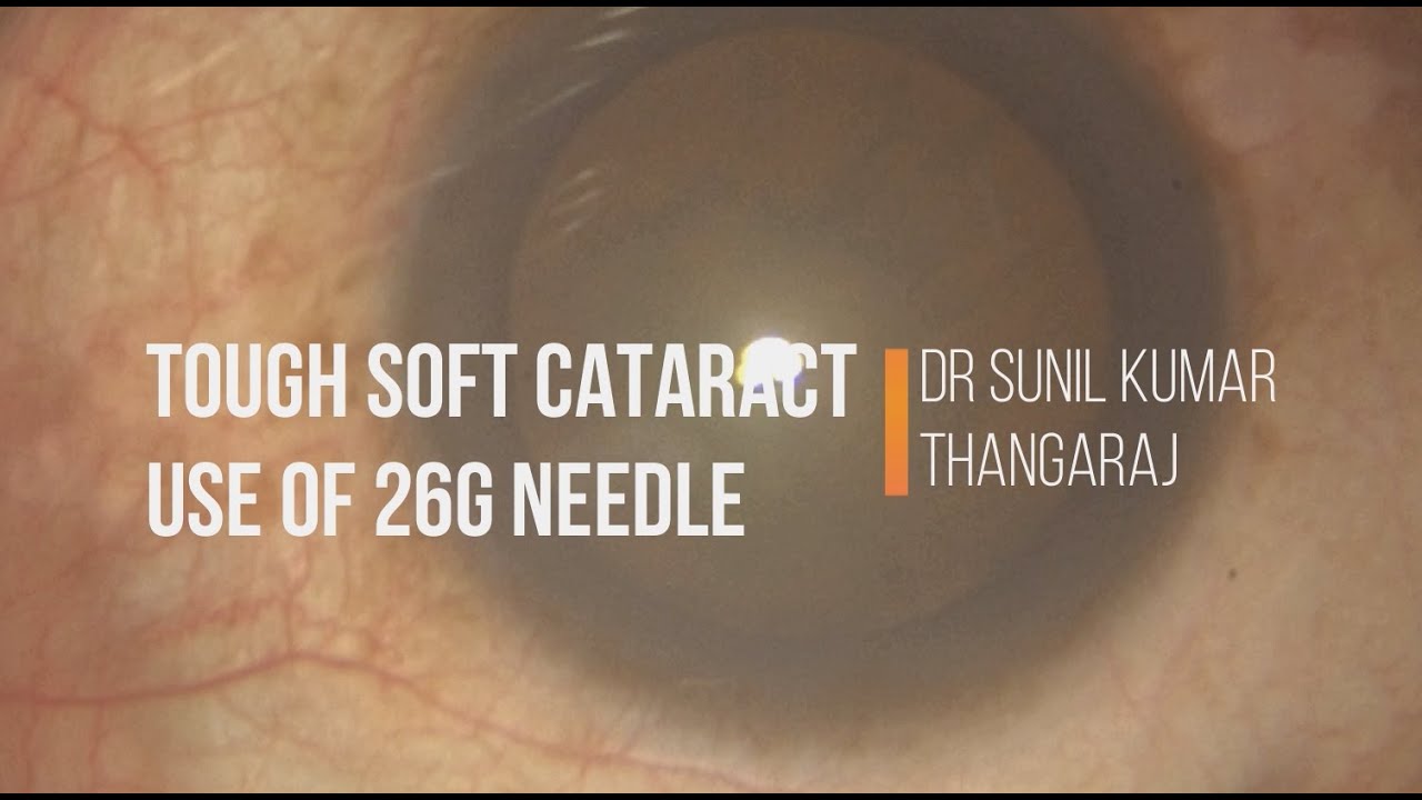The soft cataract can be extremely hard and coupled with dense PSC and ...