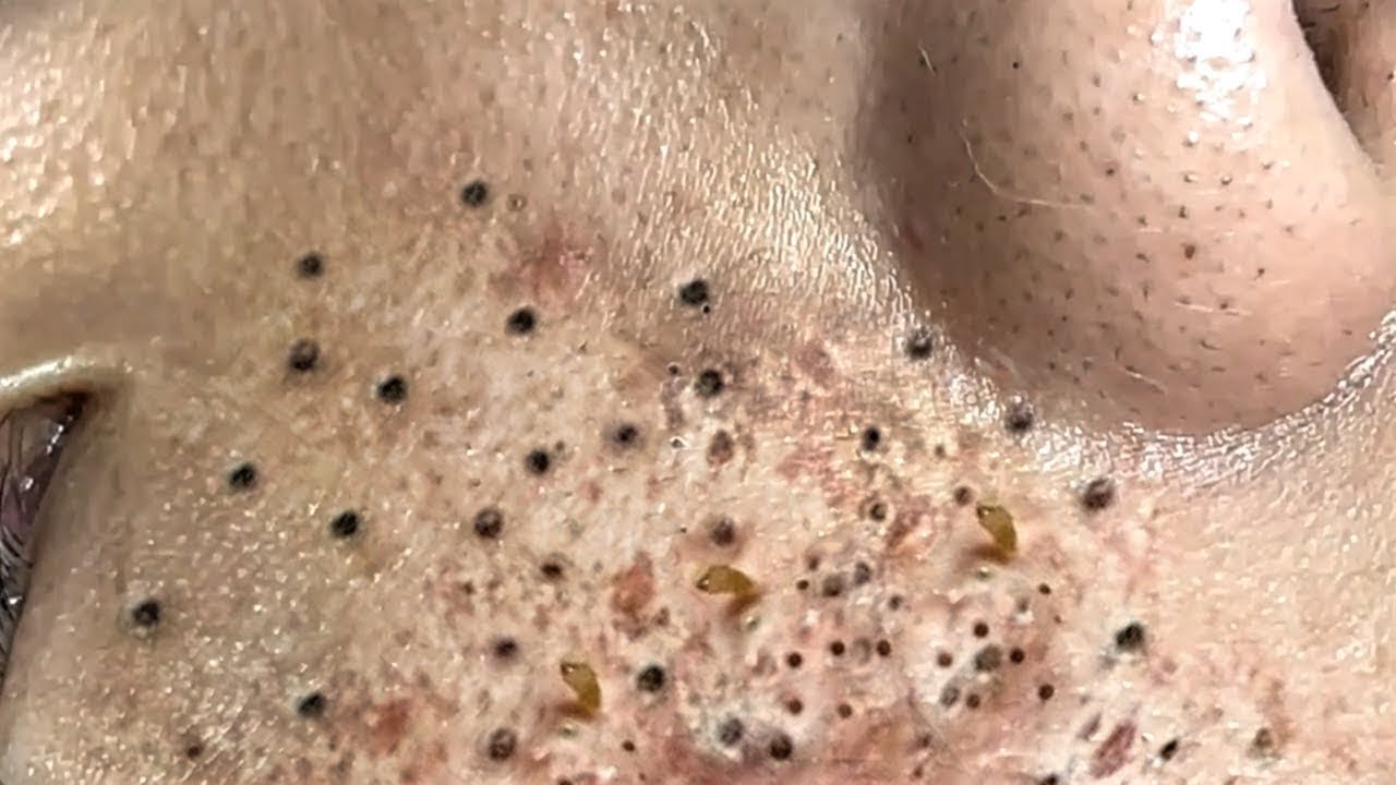 Blackheads And Milia Big Cystic Acne Blackheads Extraction Whiteheads