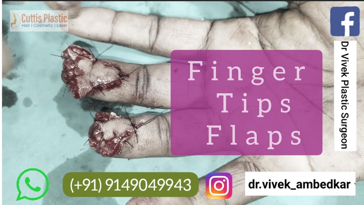 Finger Tips Flaps | Atasoy Flap | Hand Surgeon Rewa Satna Varanasi ...