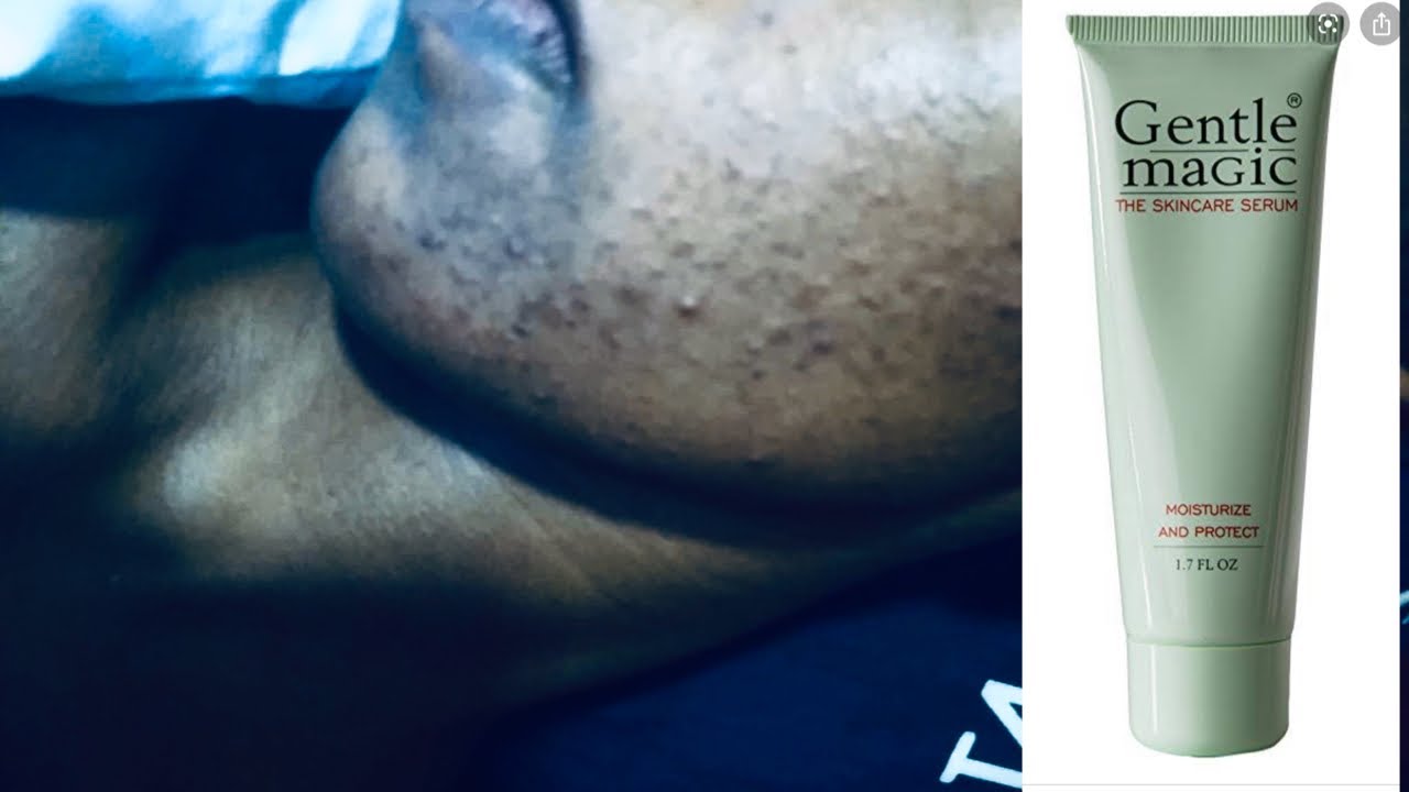 HOW I CLEARED OUT MY ACNE WITH GENTLE MAGIC | HOW I REMOVED PIMPLES ...