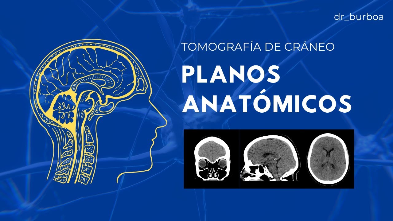 Tutorial De Anatomía Cerebral Por Tomografía Computarizada