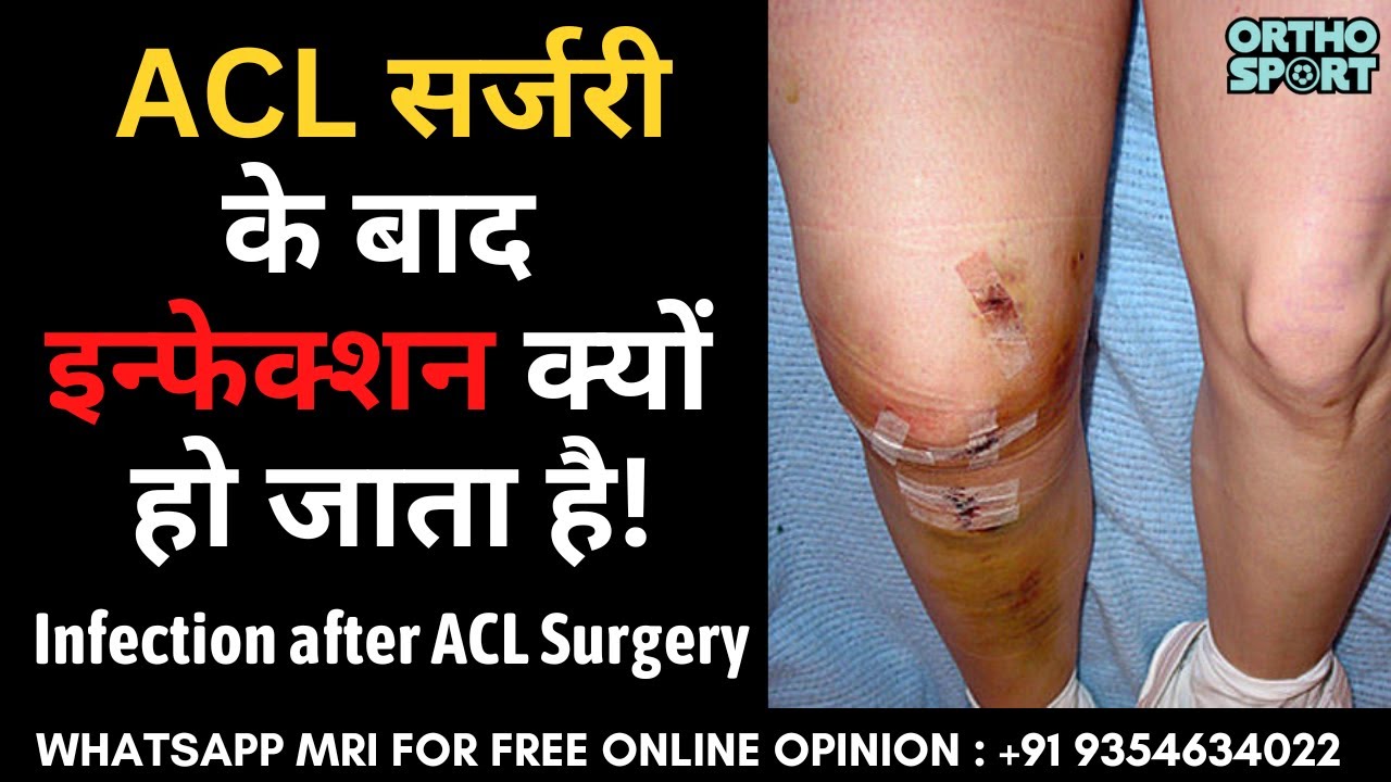 ACL Knee Infection After acl-knee-infection-after