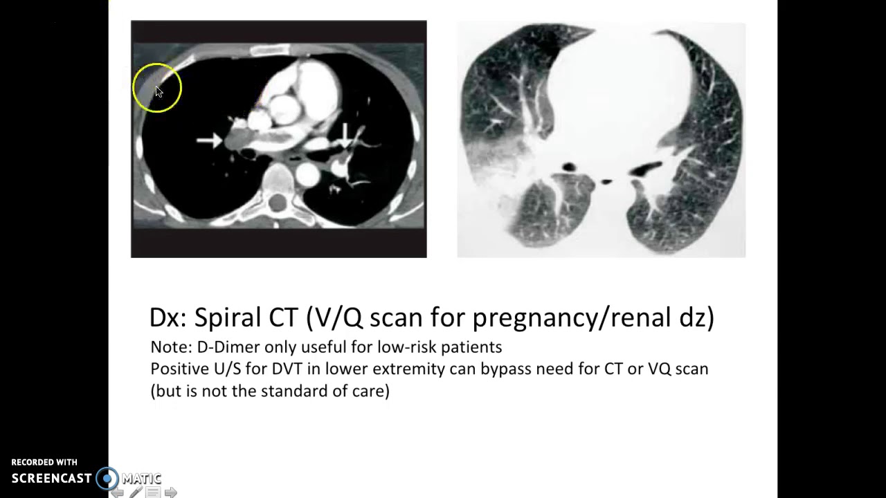 Hypoxemia and Pulmonary Embolism - YouTube