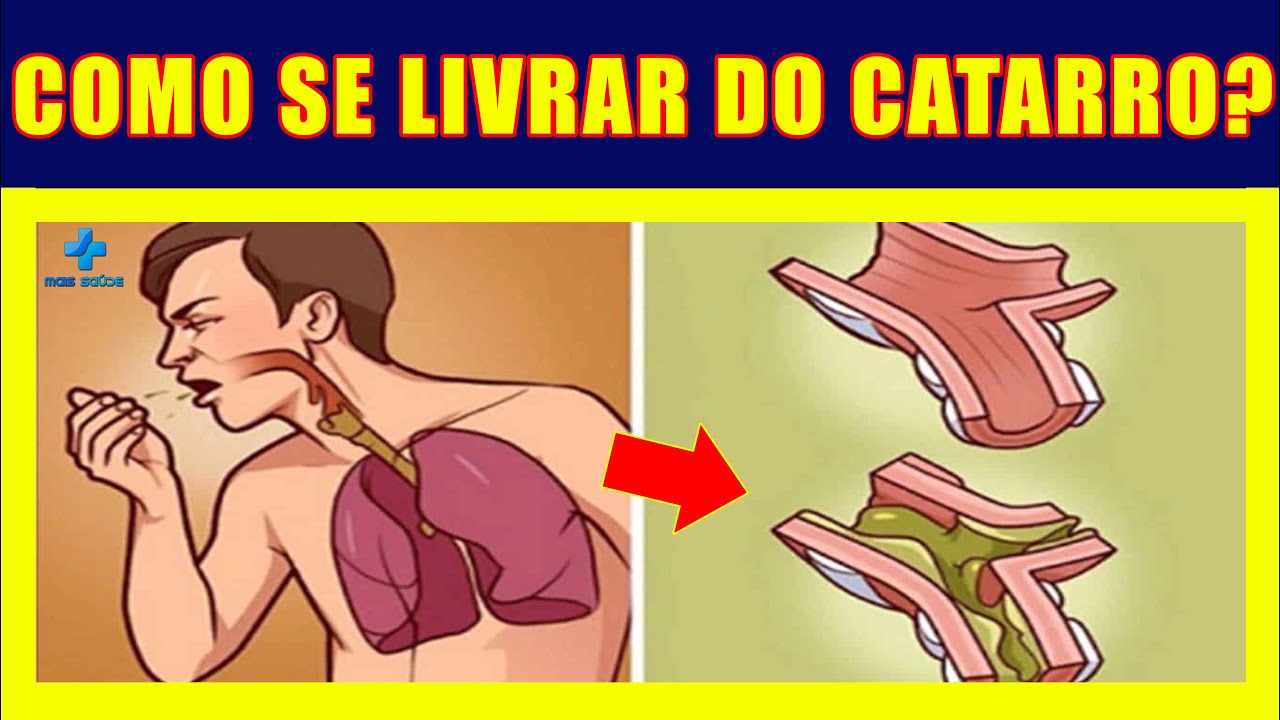 SE LIVRE DO CATARRO PRESO NO NARIZ, GARGANTA E PULMÃO - YouTube