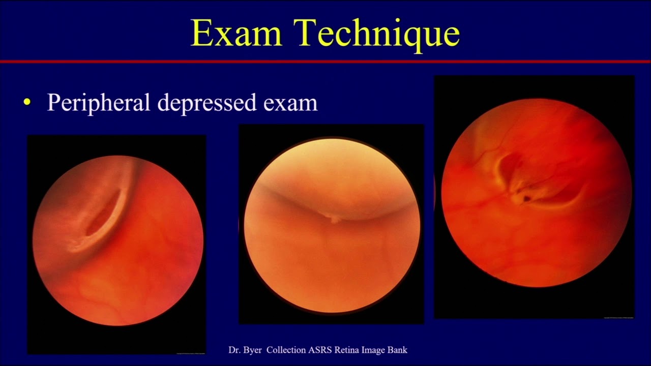 Retinal Breaks - YouTube