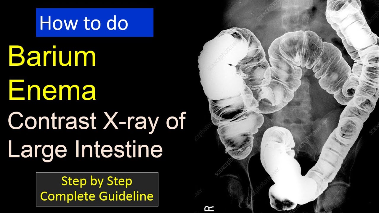 Barium Enema Technique | Single and Double Contrast | Contrast x-ray of ...