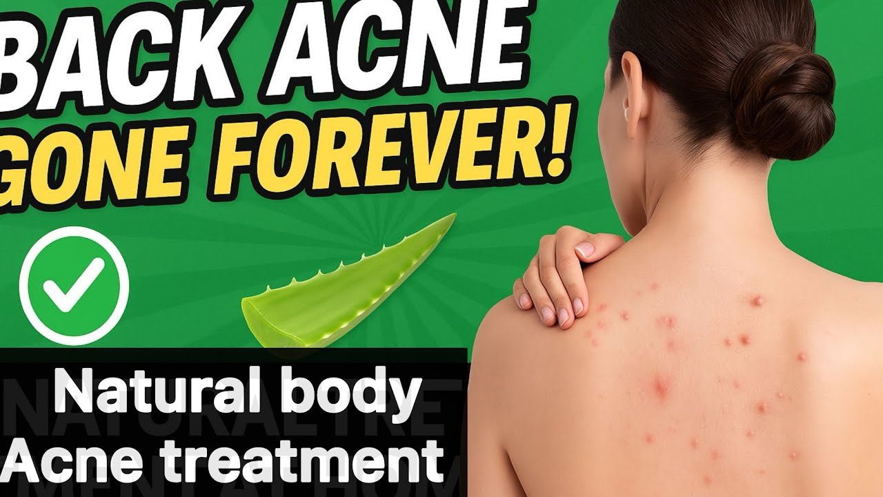 Back Acne Treatment at Home | Permanent Solution for Body Pimples ...