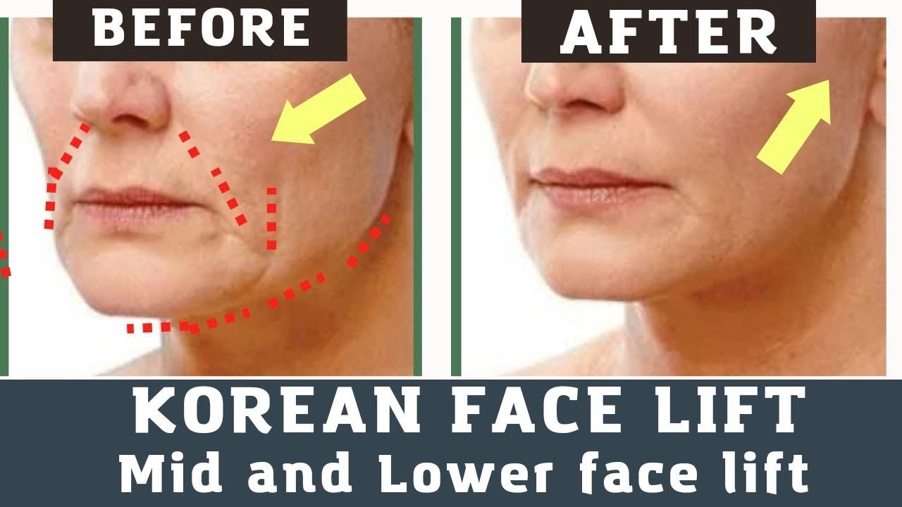 Korean face lift | Mid face lift, Lower face lift | Nasolabial folds ...