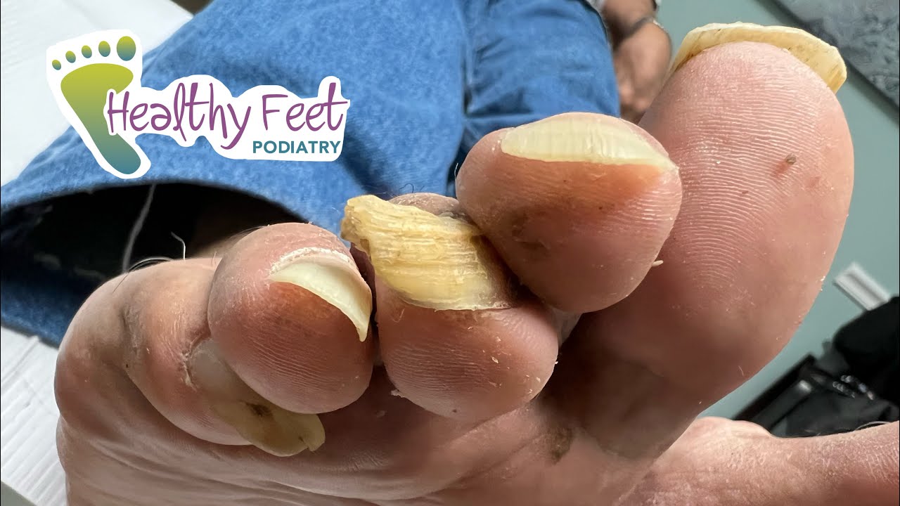 OUT OF CONTROL TOE NAILS - YouTube