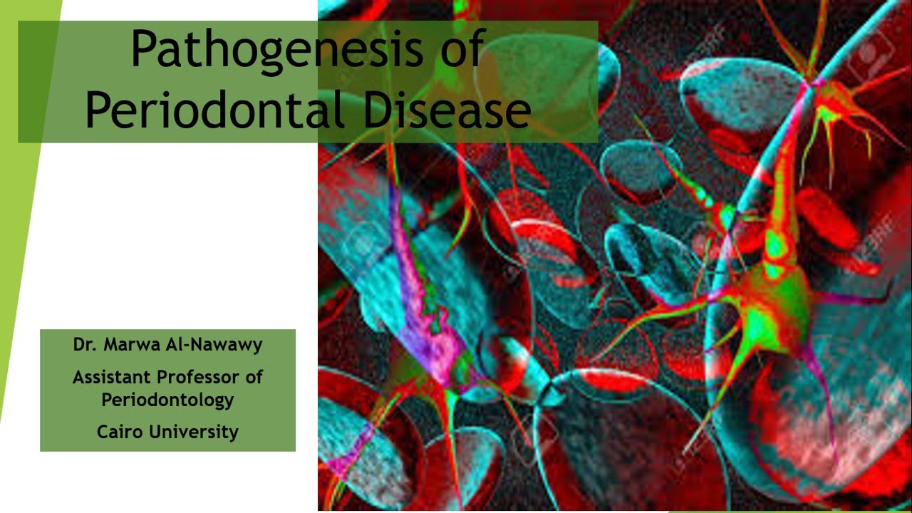 Pathogenesis of Periodontal disease part 1 - YouTube