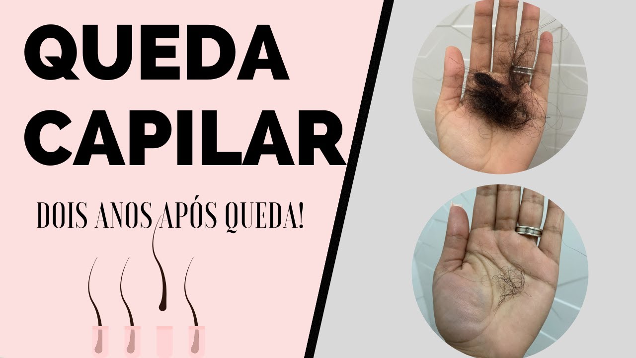 QUEDA DE CABELO: COMO VENCI MINHA QUEDA CAPILAR. - YouTube