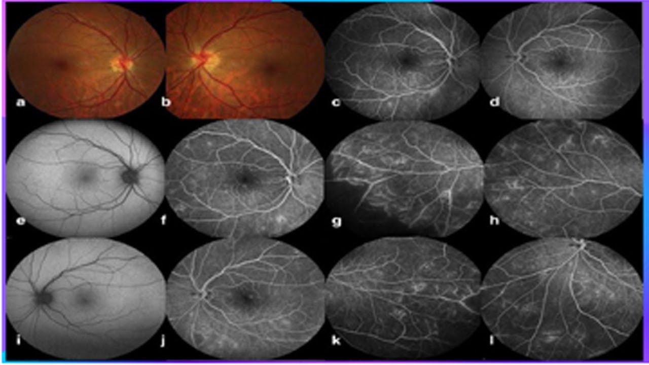 Fundus Fluorescein Angiography FFA Testing - YouTube