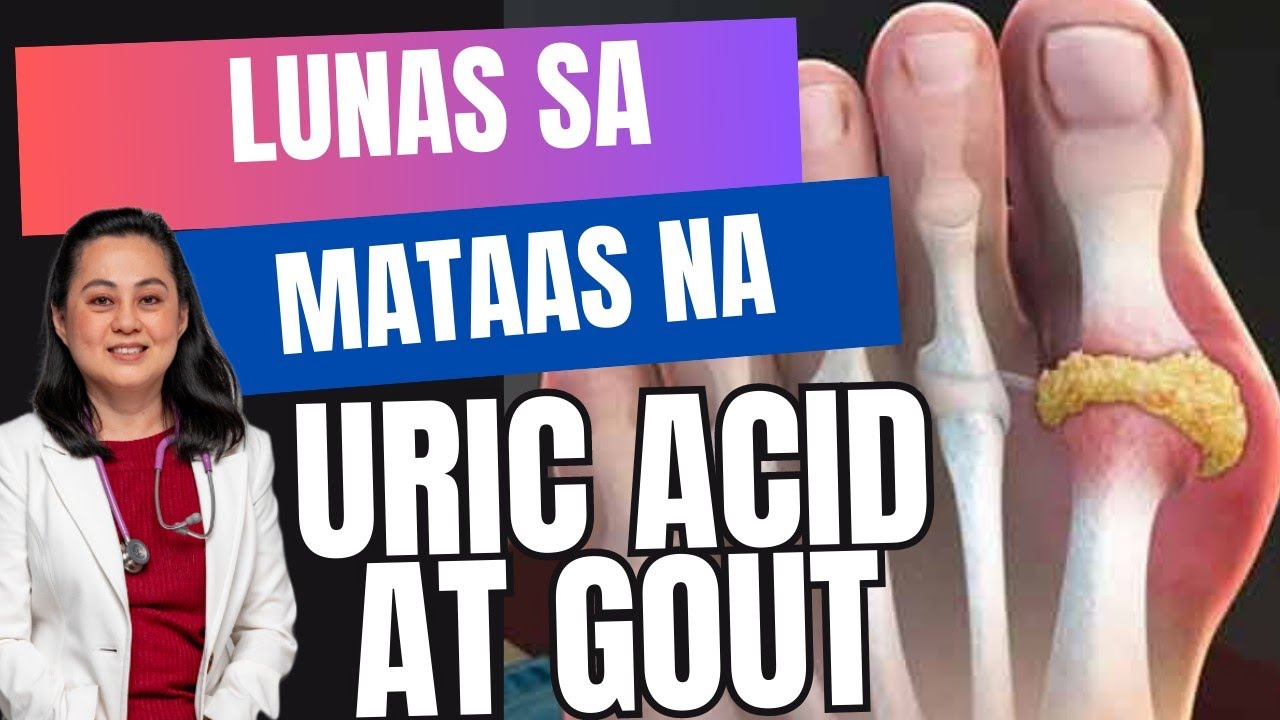 Lunas sa Mataas na Uric Acid at Gout. - Payo ni Doc Liza Ramoso-Ong ...