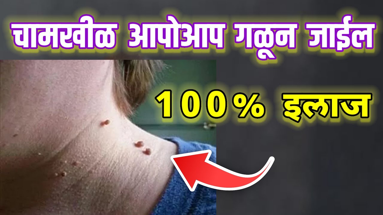 चामखीळ आपोआप गळून जाईल 100% इलाज ! Chamkhil gharguti upay - YouTube