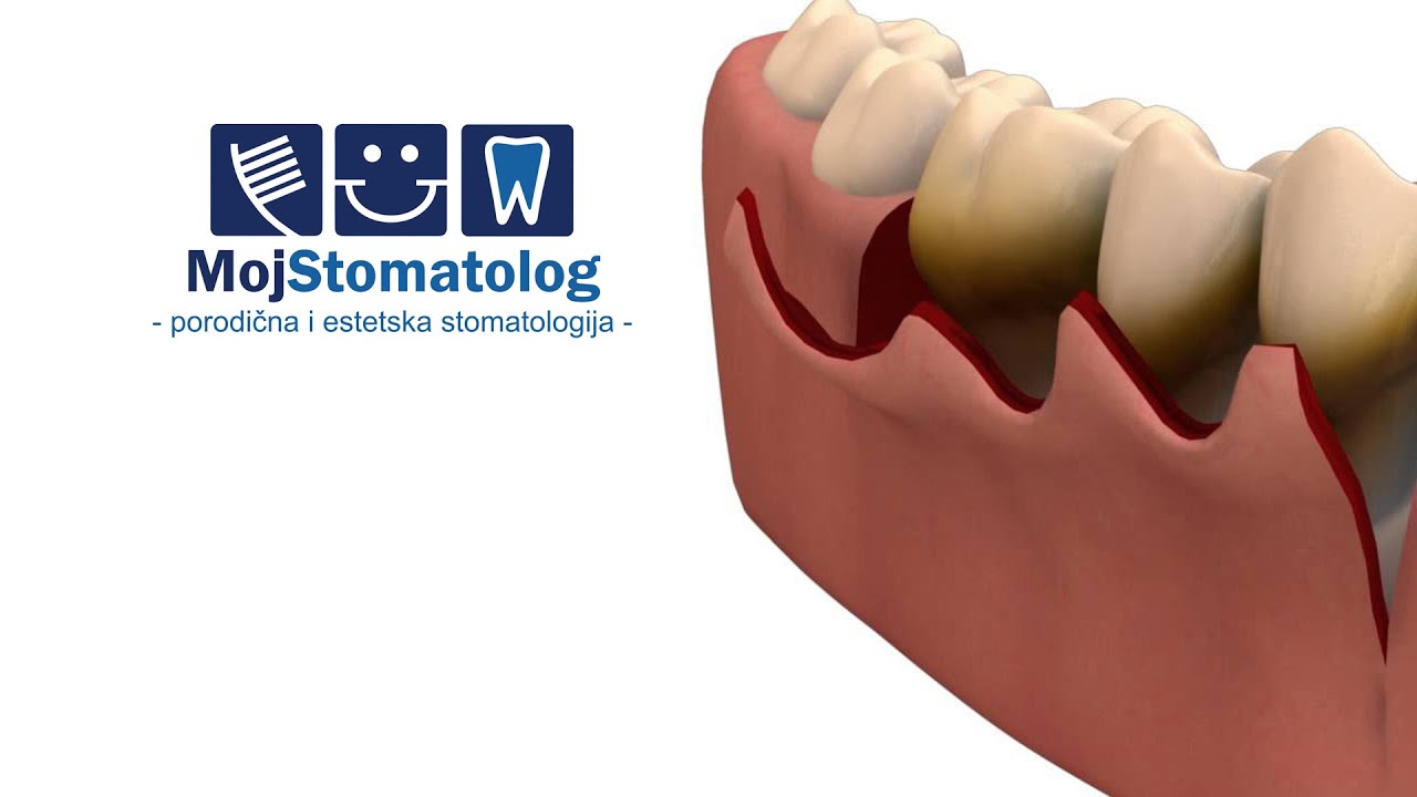 Režanj operacija - YouTube