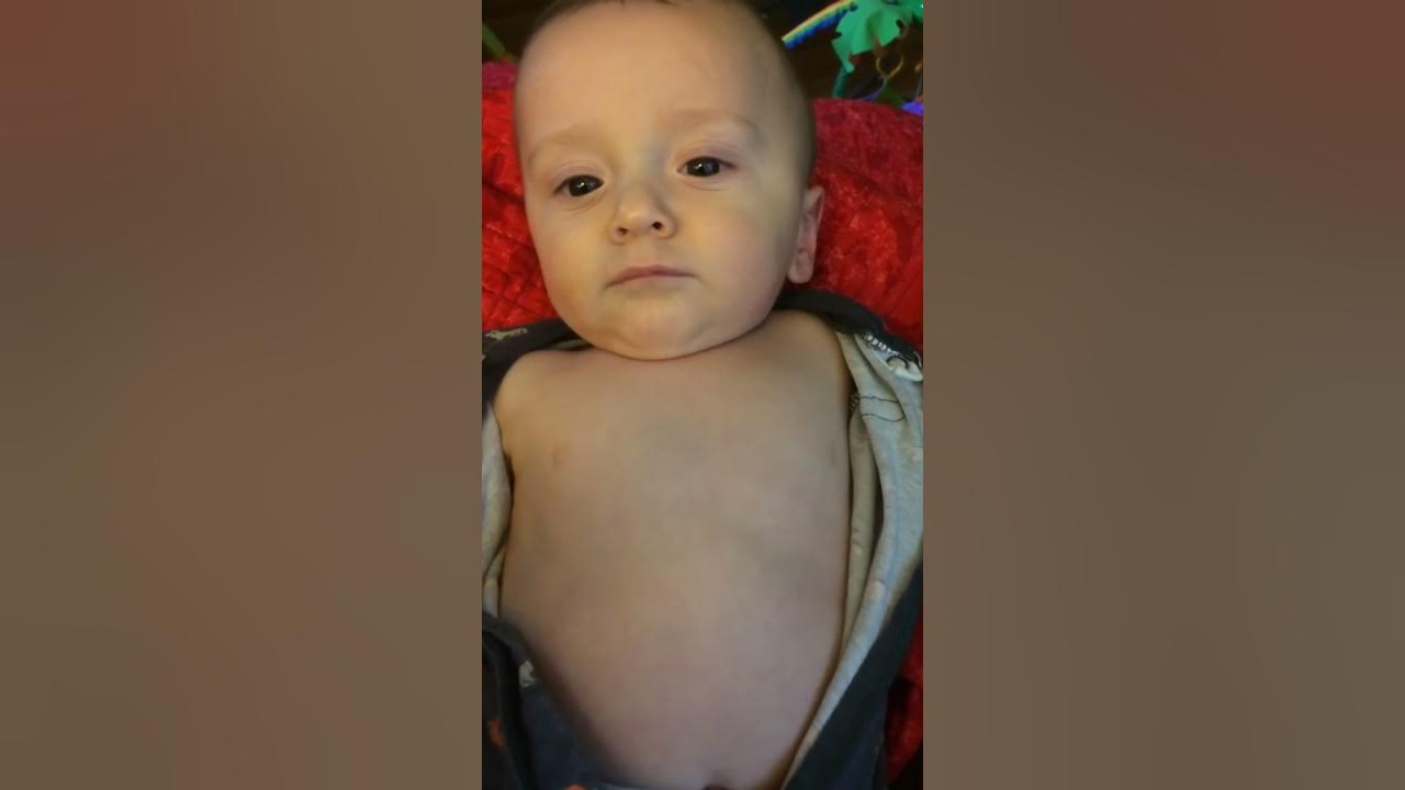 Nasal Flaring And Substernalsubcostal Retractions In Infant Youtube