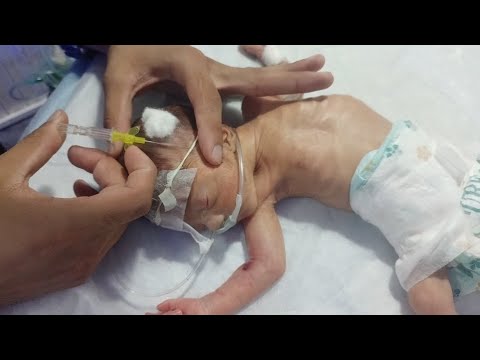 "How to Pass Complicated IV Line in the Head of a Newborn Baby" - YouTube