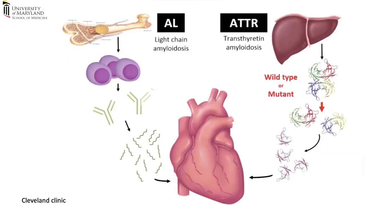 Cardiac Amyloidosis Interpretation Best Practices Youtube
