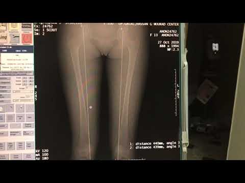 ازاي تعمل فحص scanogram and anteversion علي جهاز GE - YouTube