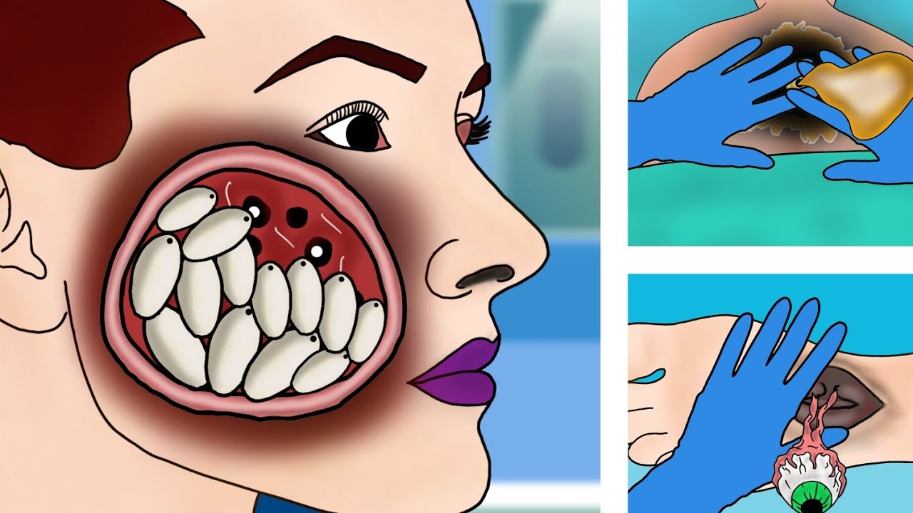 ASMR CARE ANIMATION COLLECTION | Dirty Pimple,Toes Cleaning,Acne[DEEP ...