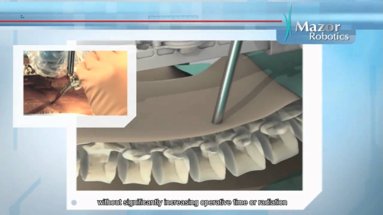Mazor Robotics SpineAssist (2010) - YouTube