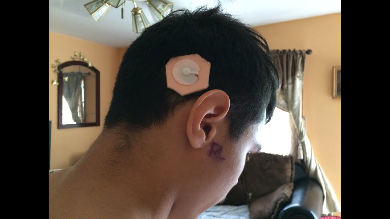 BAHA 4 Surgery Experience - Single-sided deafness - YouTube