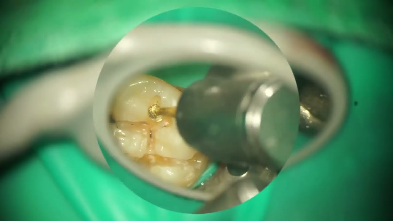 Maxillary Second Molar Caries Removal Under Mirror View - YouTube