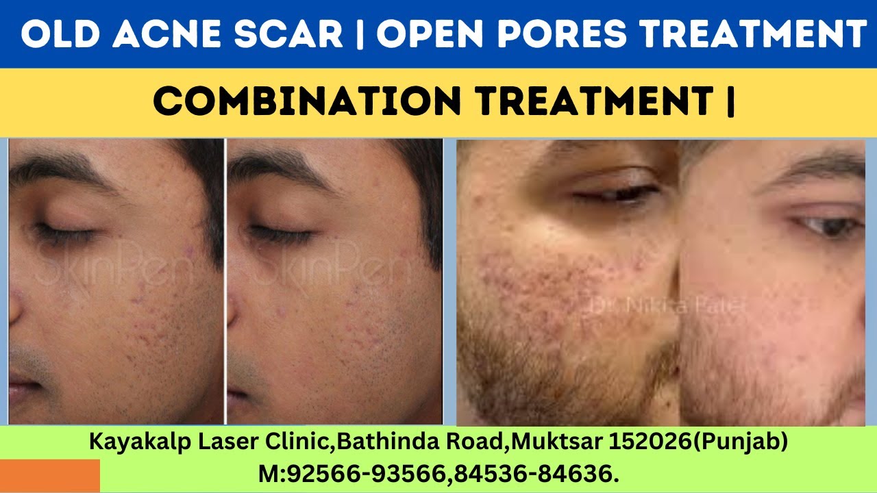 Old Acne Scar | Open Pores Treatment | Combination Treatment | Kayakalp ...