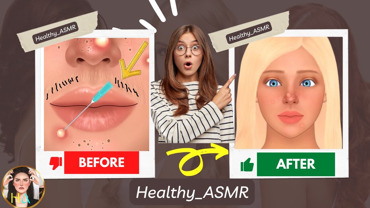 ASMR Relaxing Blackhead and Pimple Removal Animation for a Soothing ...